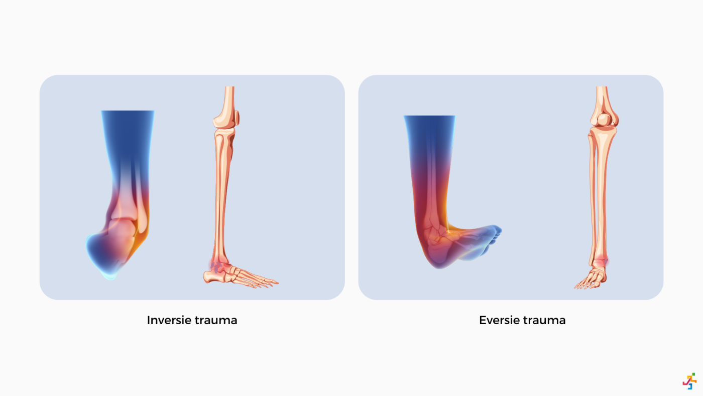 Veel voorkomende sportblessures: een enkeldistorsie - Sportieq - Gezond ...